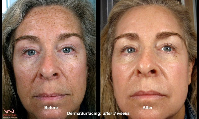 What is Sun-Damage And How To Treat It - West LA