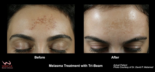 What Is Melasma? Treatments And Causes - West LA